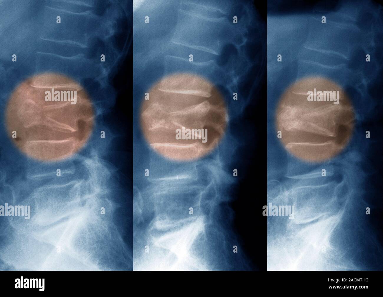 Osteoporosis of the spine. X-rays of the lumbar (lower back) vertebrae ...