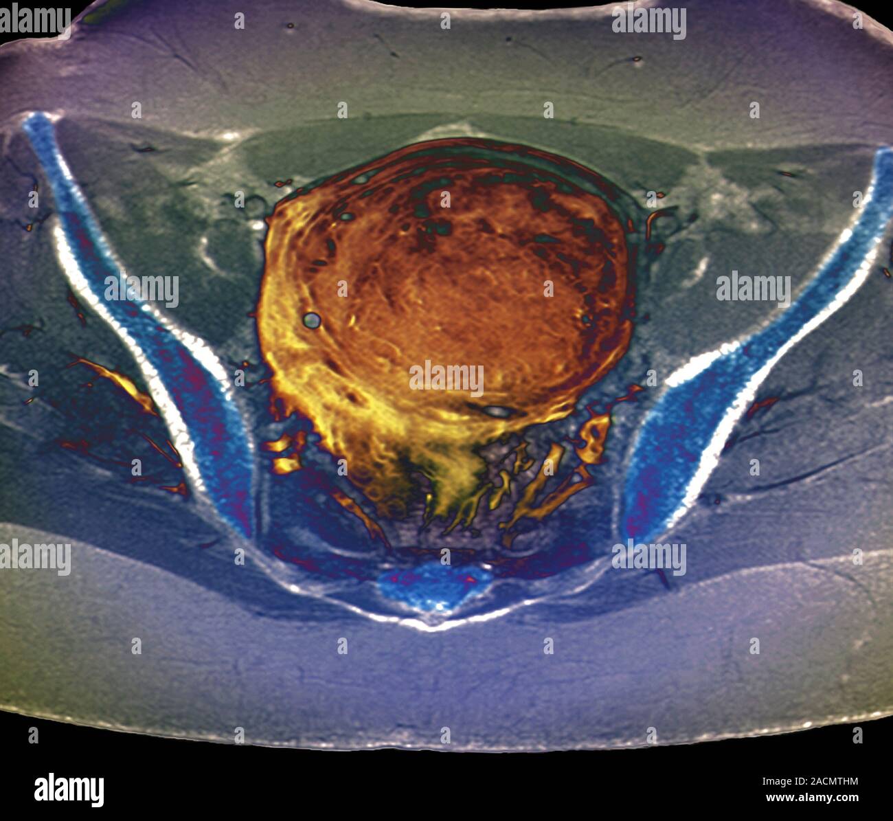 Uterus tumour. Coloured X-ray of a 36-year-old woman with a large ...