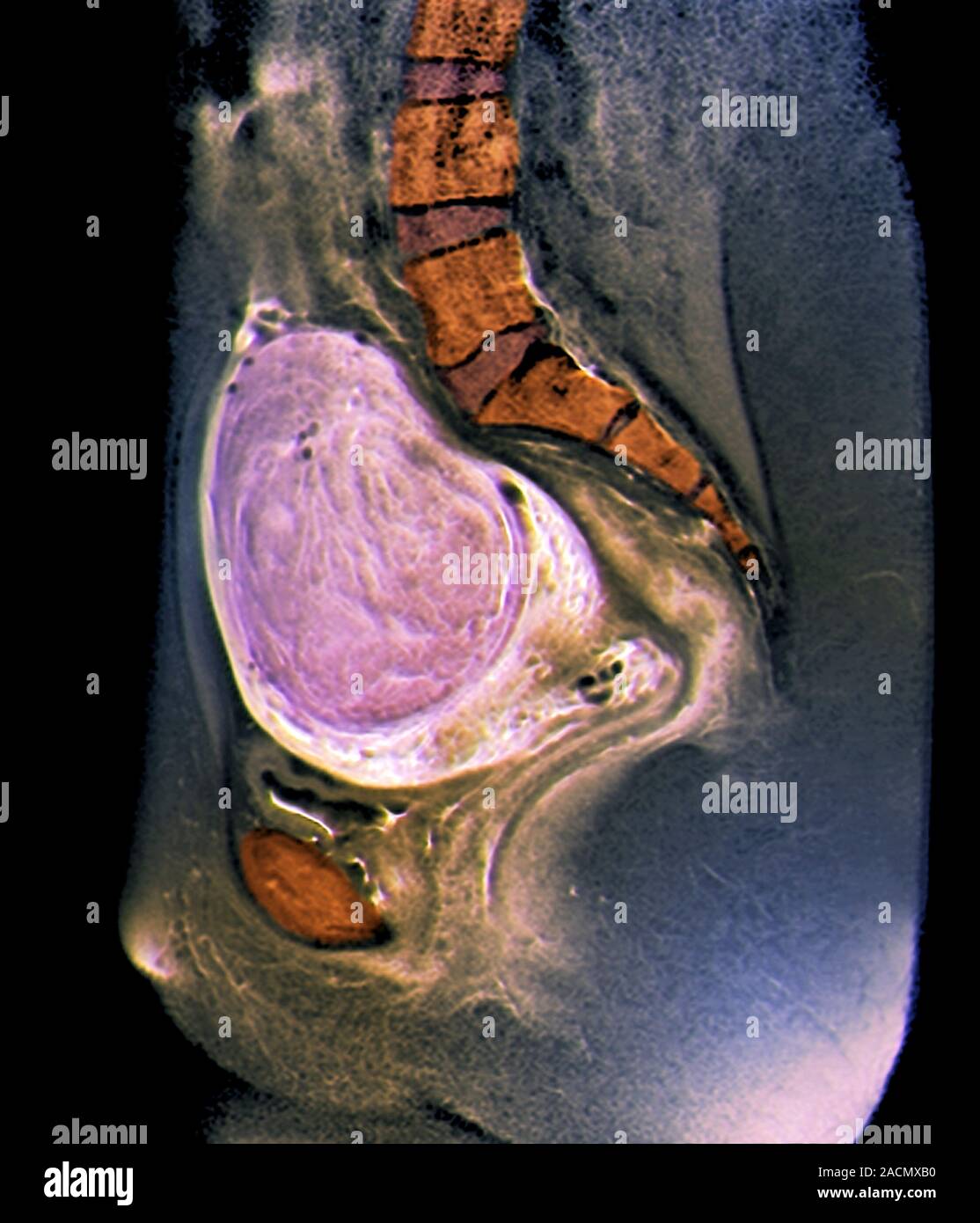 Uterus tumour. Coloured X-ray of a 36-year-old woman with a large ...