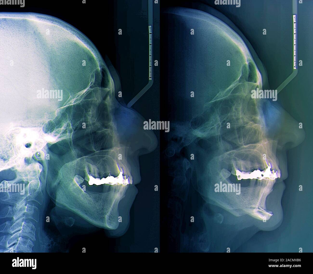 Facial plastic surgery. X-ray of the head of a 48-year-old patient ...