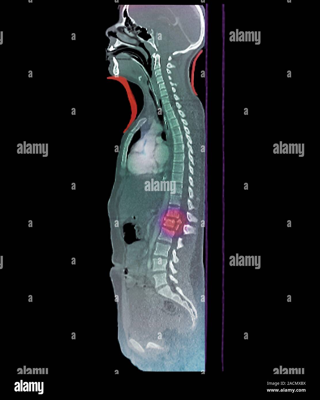 Spine Fracture Coloured Whole Body Computed Tomography Ct Scan Of The Spine Of A 16 Year Old