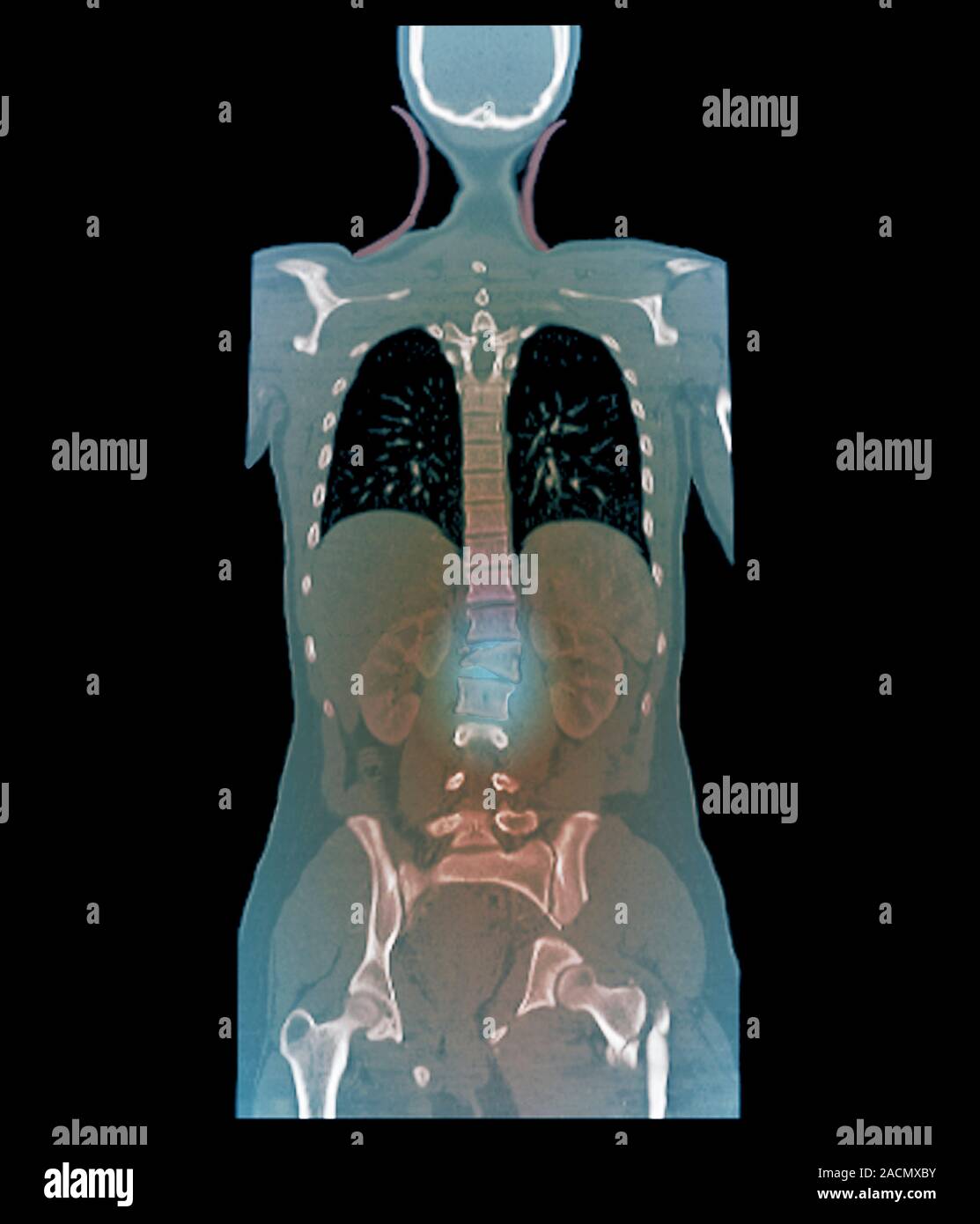 Traffic accident injuries. Coloured frontal whole-body computed ...
