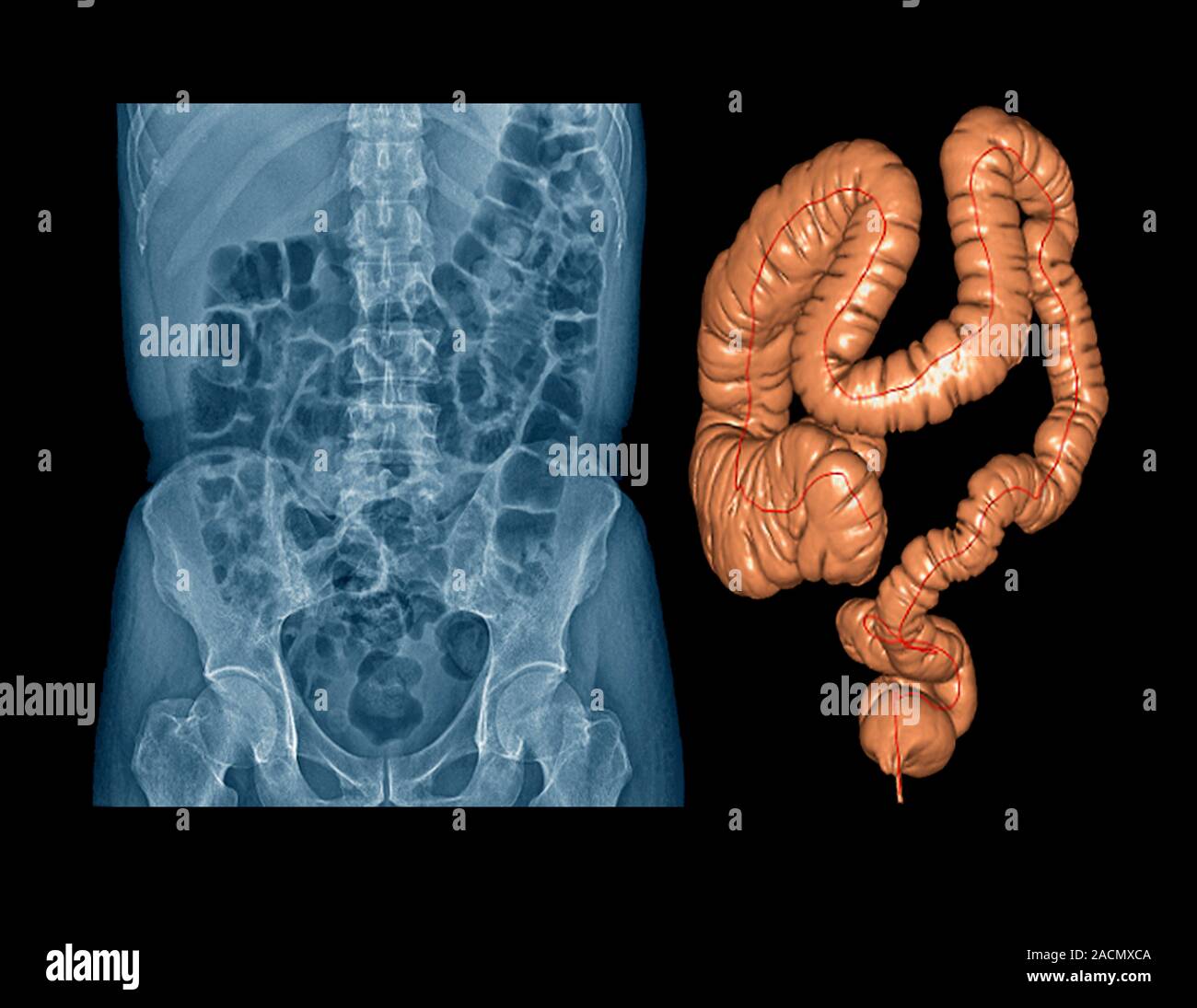 Healthy large intestine. X-ray (left) and coloured 3D computed ...
