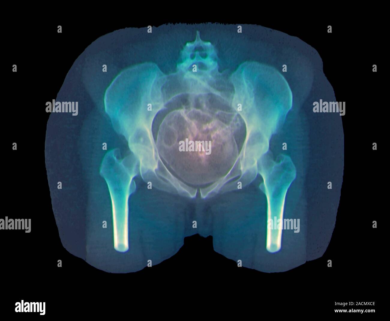 Full term foetus. Coloured computed tomography (CT) scan of a full term ...