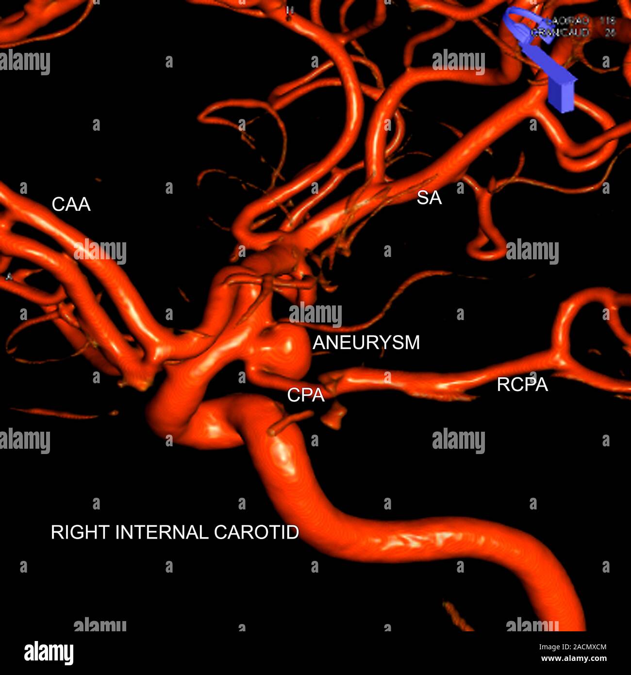 Brain aneurysm. Coloured 3D angiogram of the head of a 38-year-old ...