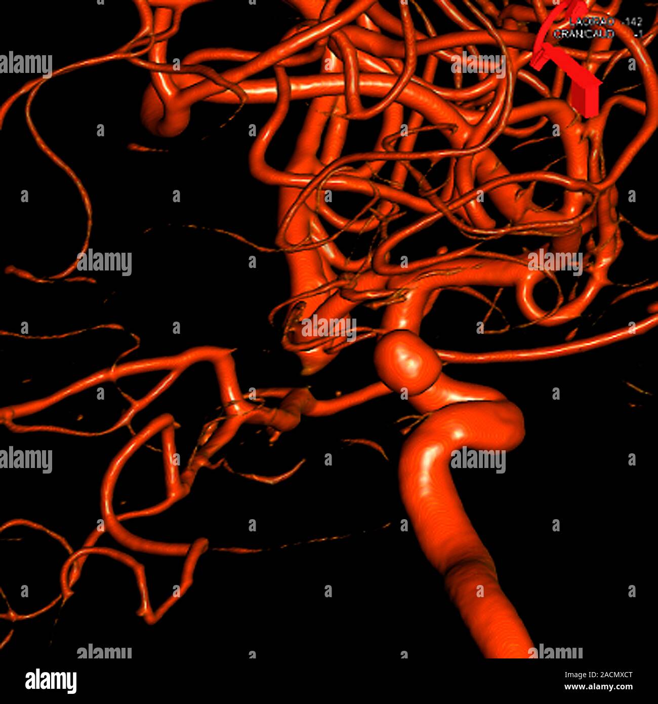 Brain aneurysm. Coloured 3D angiogram of the head of a 38-year-old ...