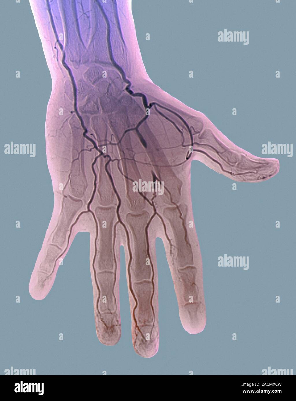 Ischaemia. Digital angiogram of a 40-year-old patient's left hand ...