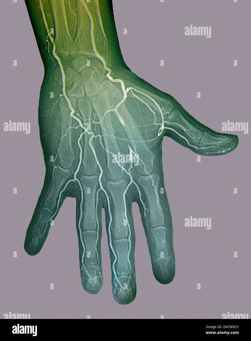 Ischaemia. Digital angiogram of a 40-year-old patient's left hand ...