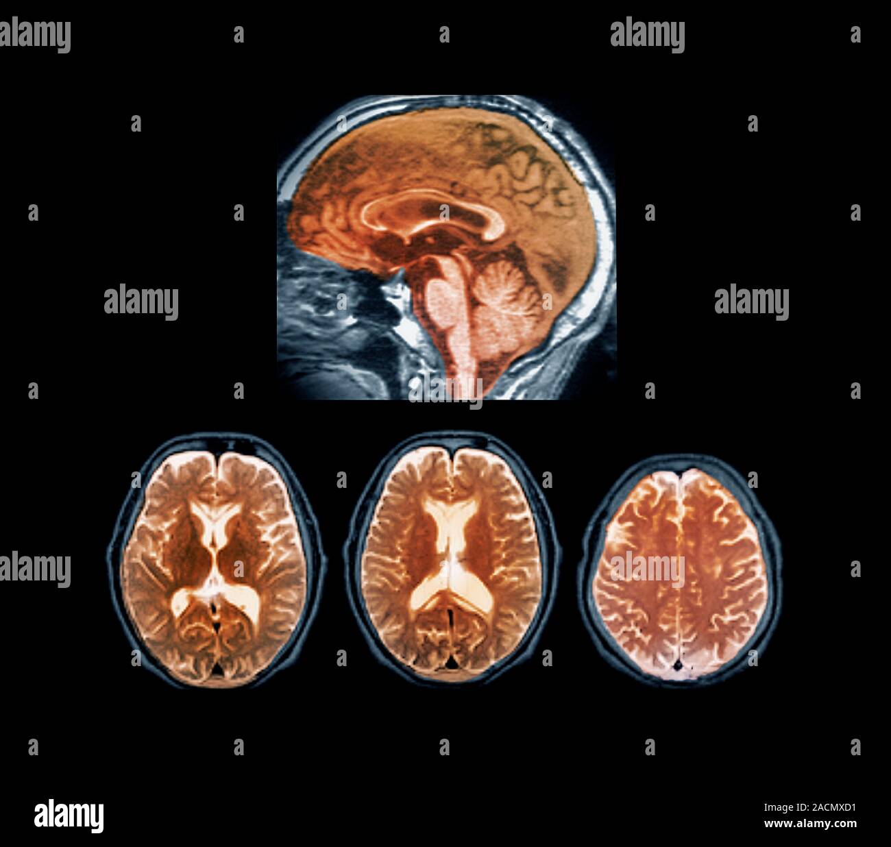 Marchiafava-Bignami disease. Coloured magnetic resonance imaging (MRI ...