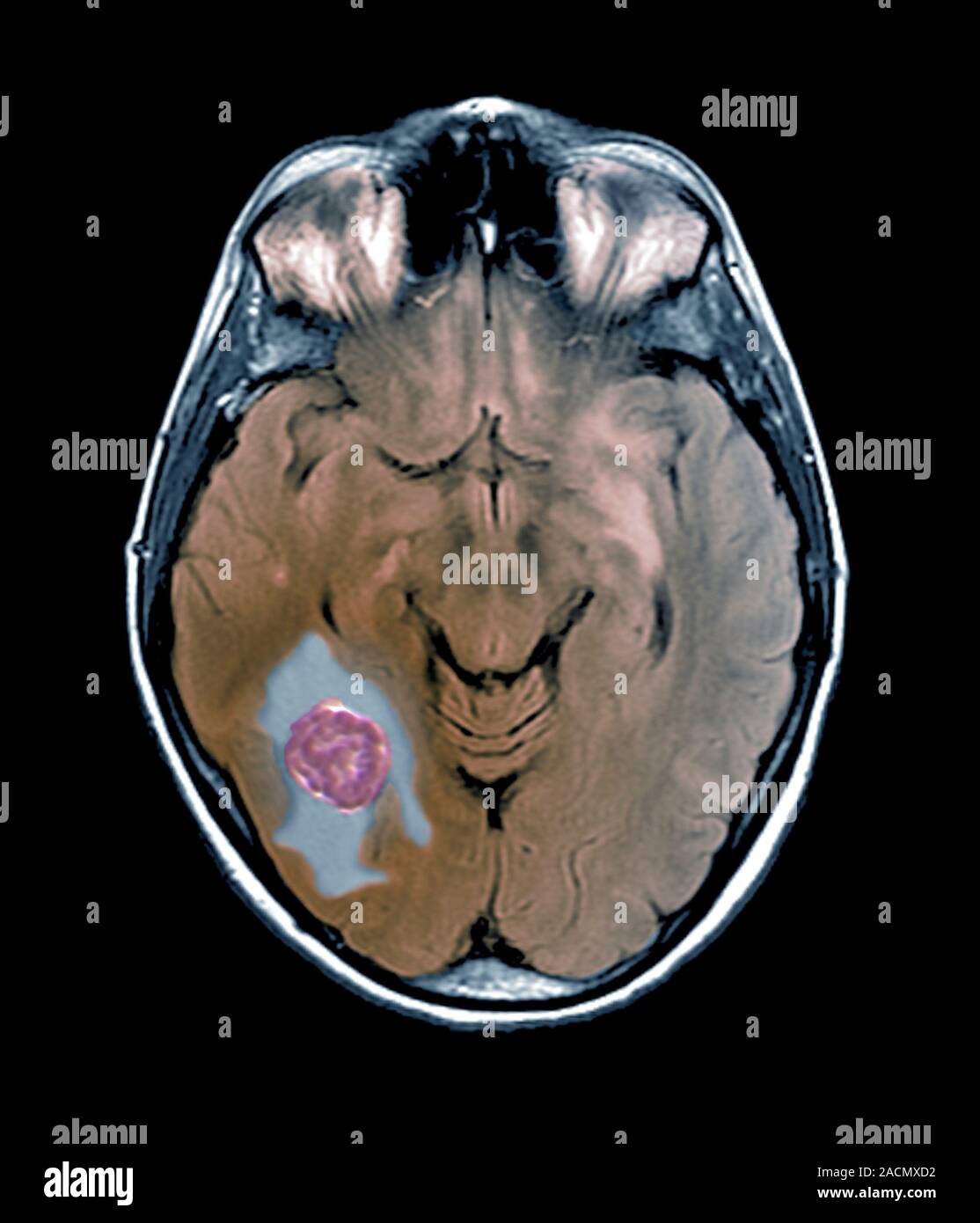 Brain cancer. Coloured magnetic resonance imaging (MRI) scan of a ...
