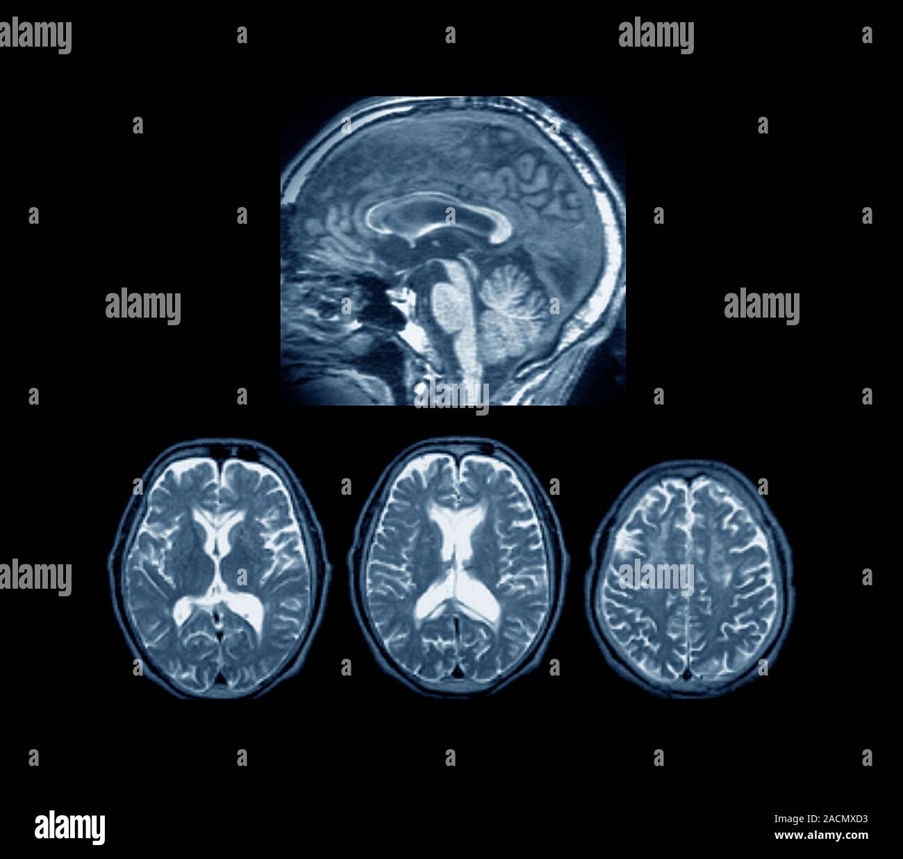 Marchiafava-Bignami in alcoholism. Magnetic resonance imaging (MRI ...