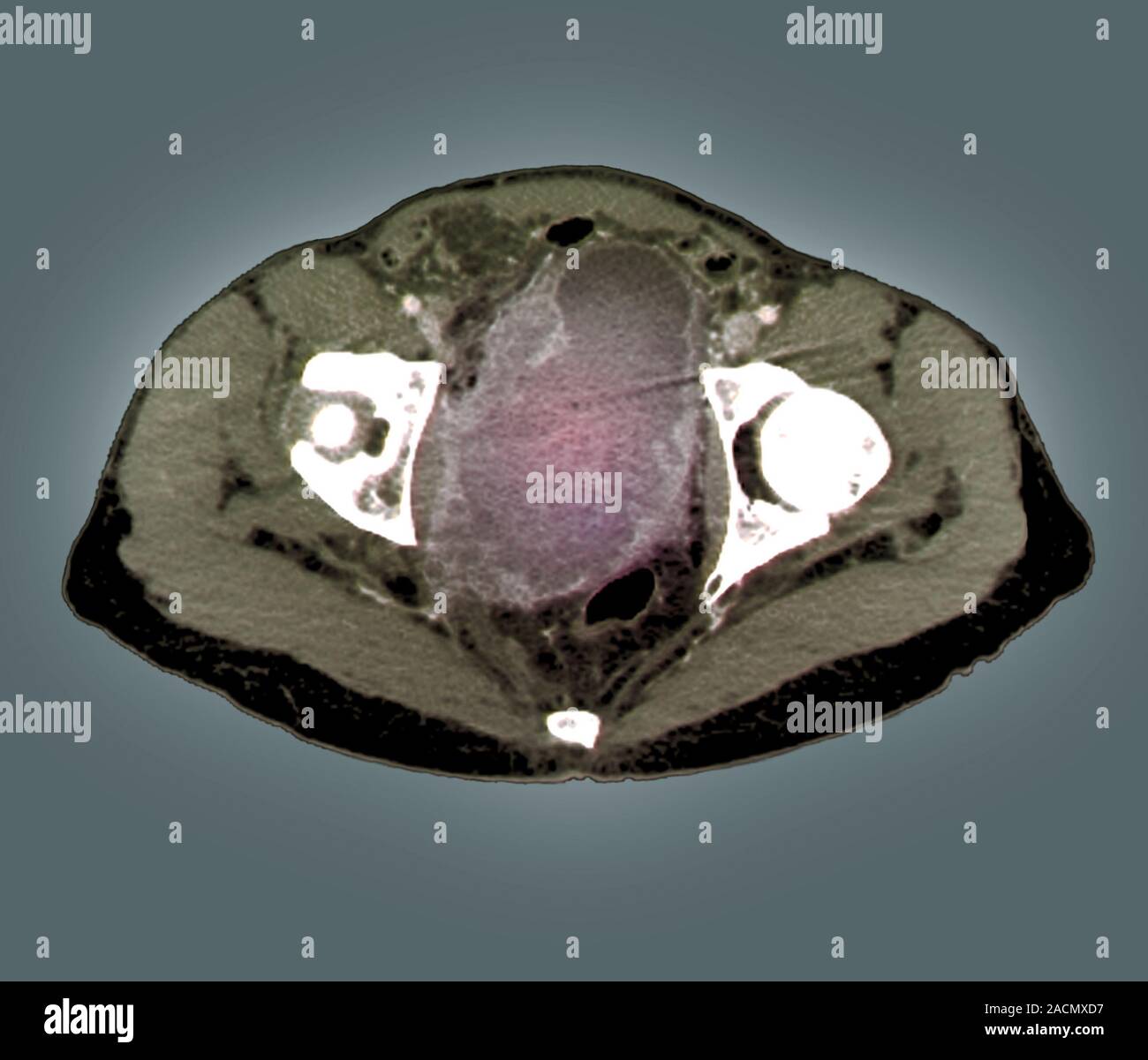 Bladder cancer. Coloured computed tomography (CT) scan of an axial ...