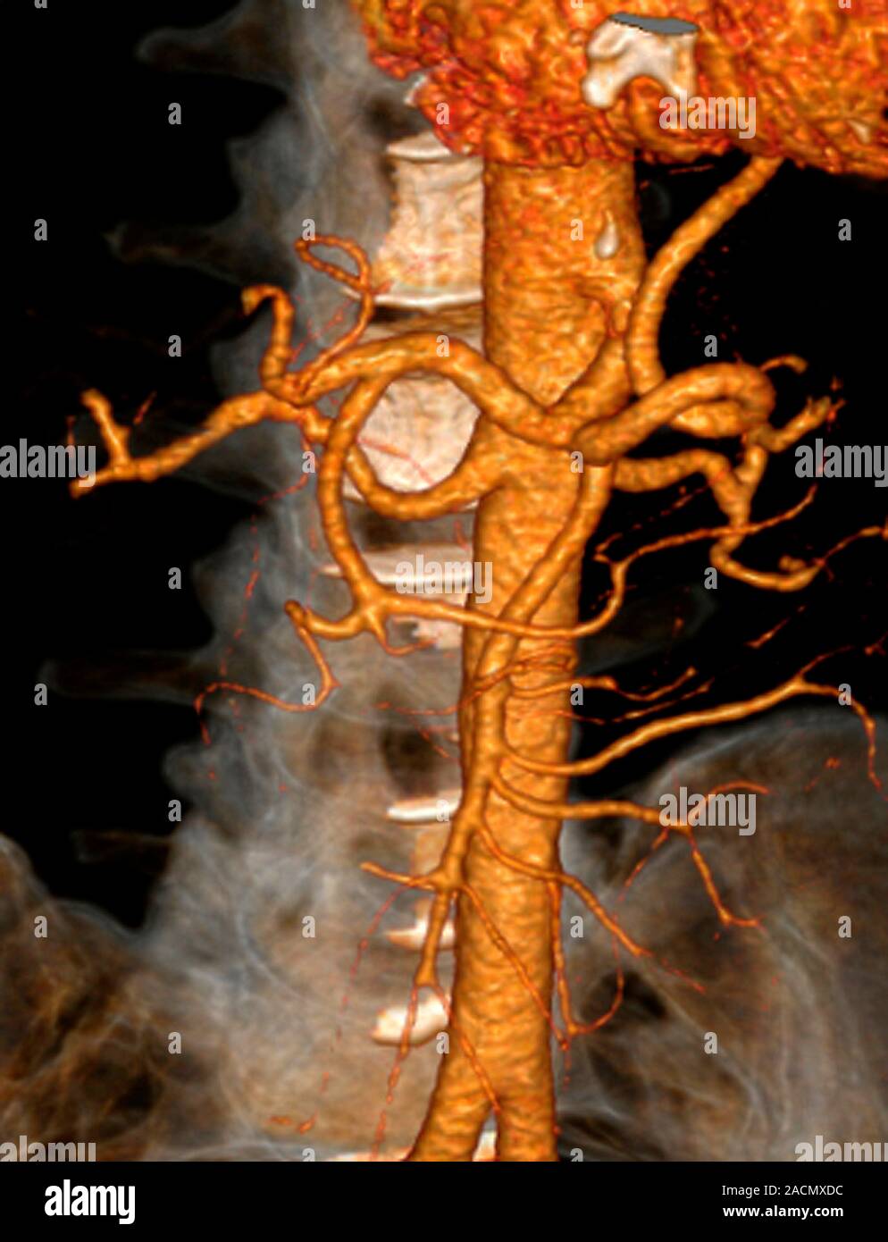 Abdominal aorta. 3D computed tomography (CT) angiogram of the abdomen ...