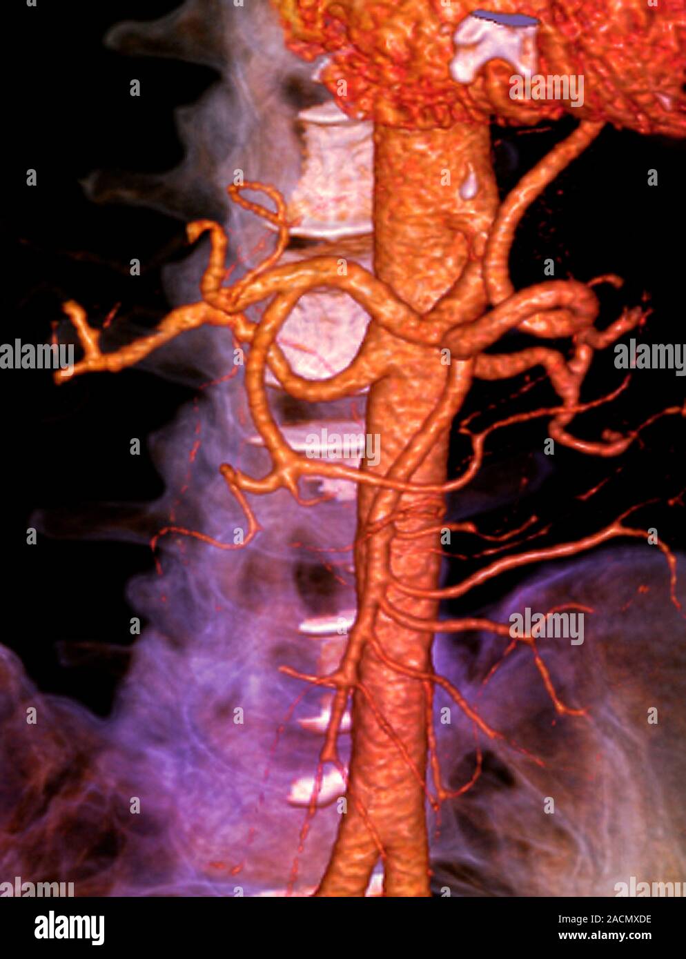 Abdominal aorta. 3D computed tomography (CT) angiogram of the abdomen ...