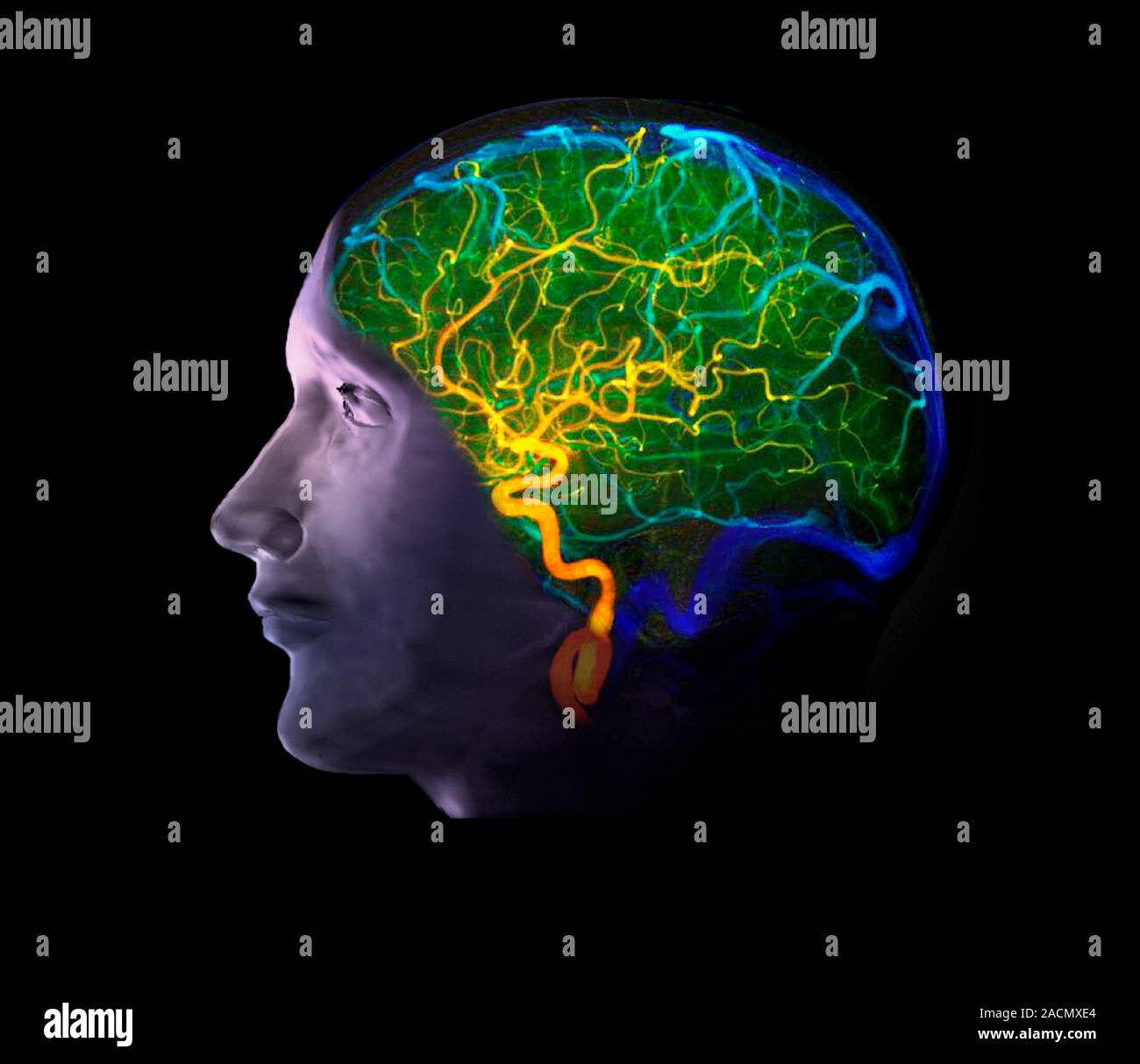 Human brain's blood supply. Coloured angiogram of a 32-year-old's brain ...