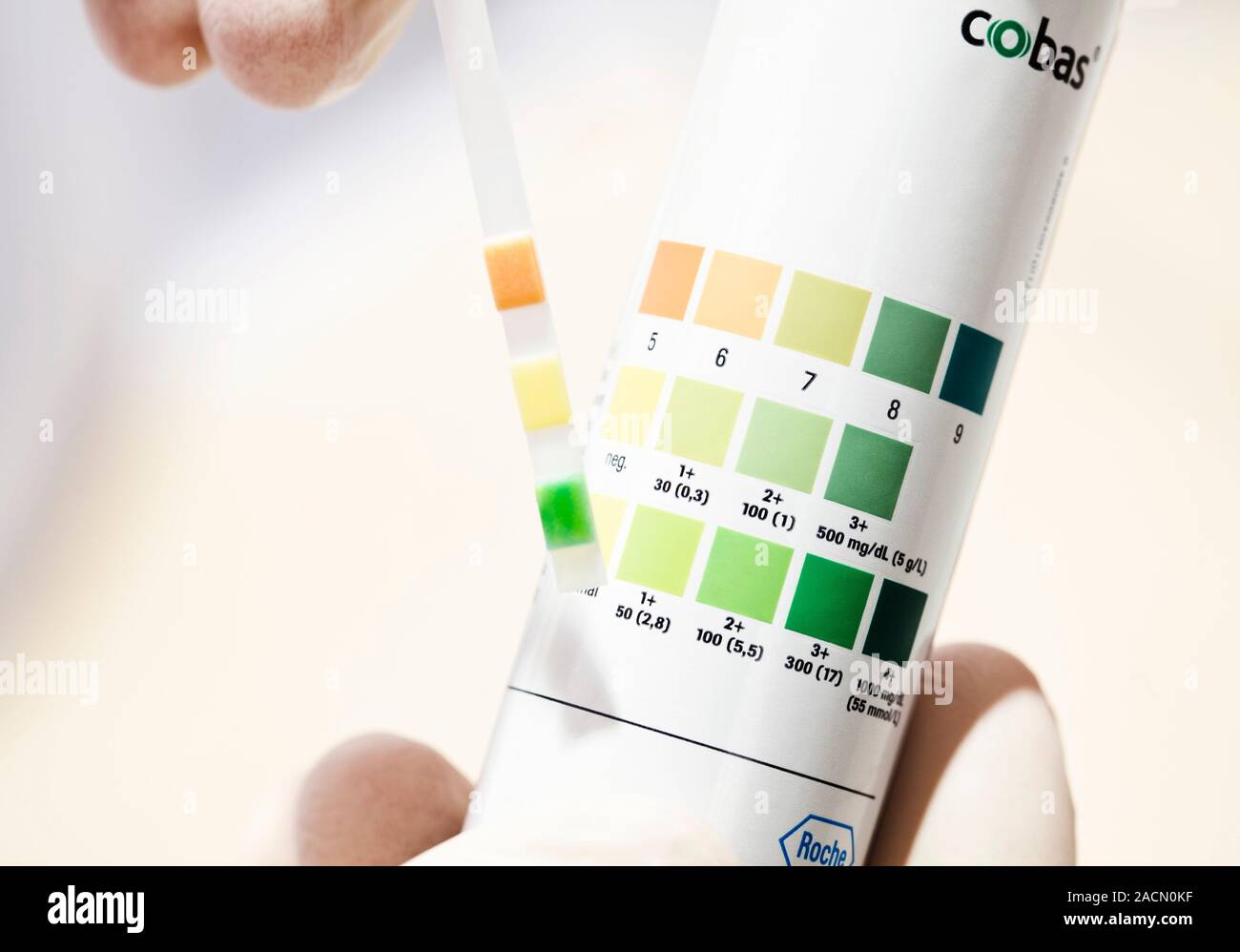 Urine test. Urine test strip being compared to the results chart on the ...