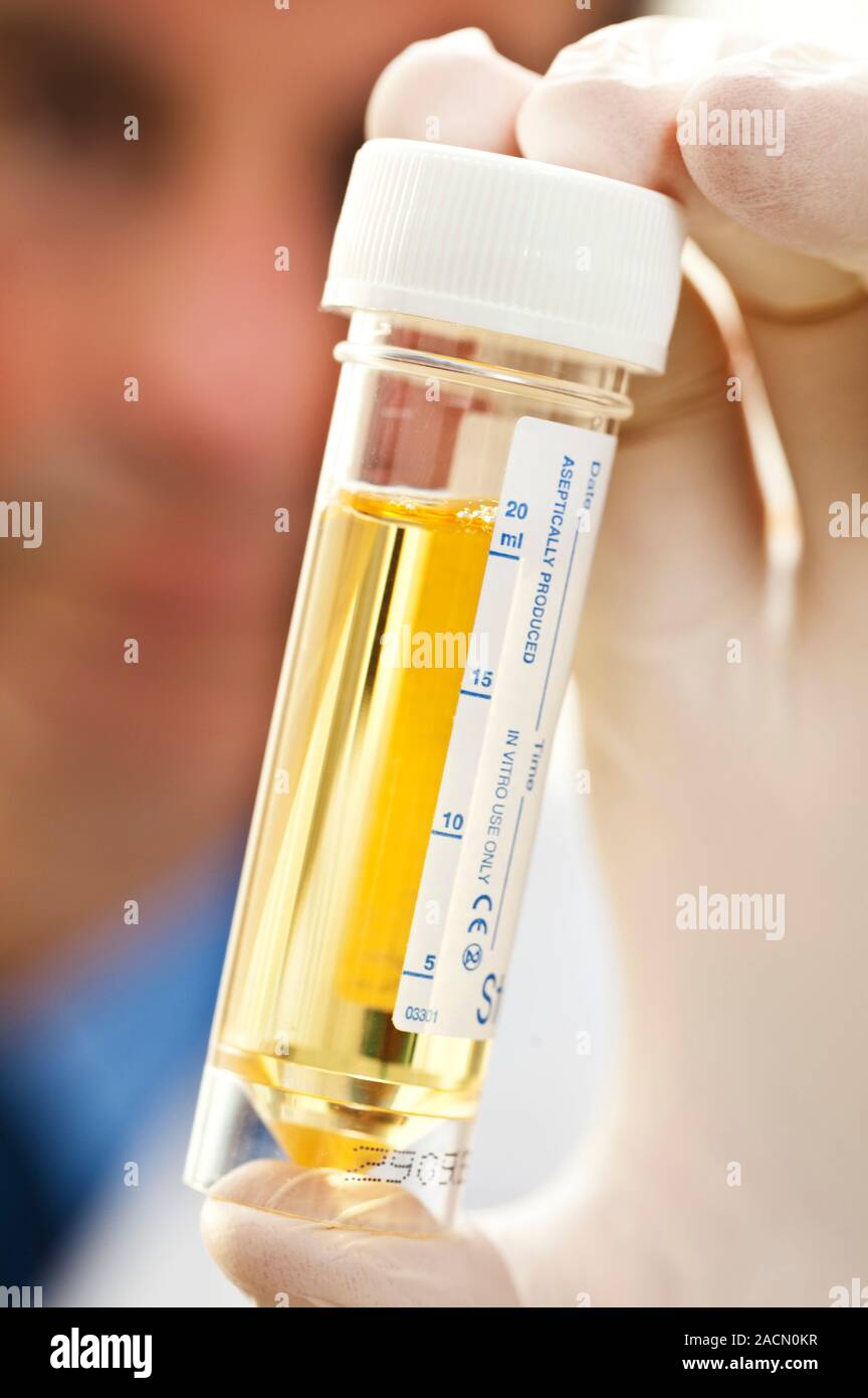 Urine sample. Close-up of a urine sample held by a medical worker in ...