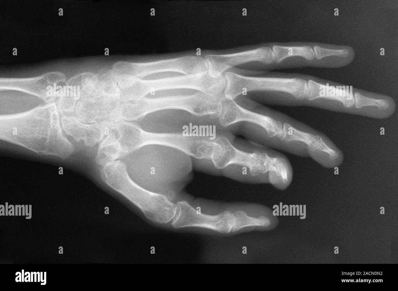 Rheumatoid arthritis of the left hand, X-ray. Rheumatoid arthritis is ...