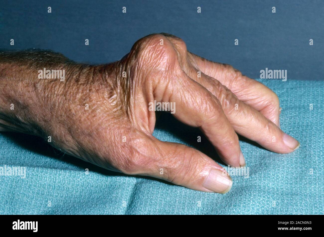 Rheumatoid arthritis of the left hand. Rheumatoid arthritis is an ...