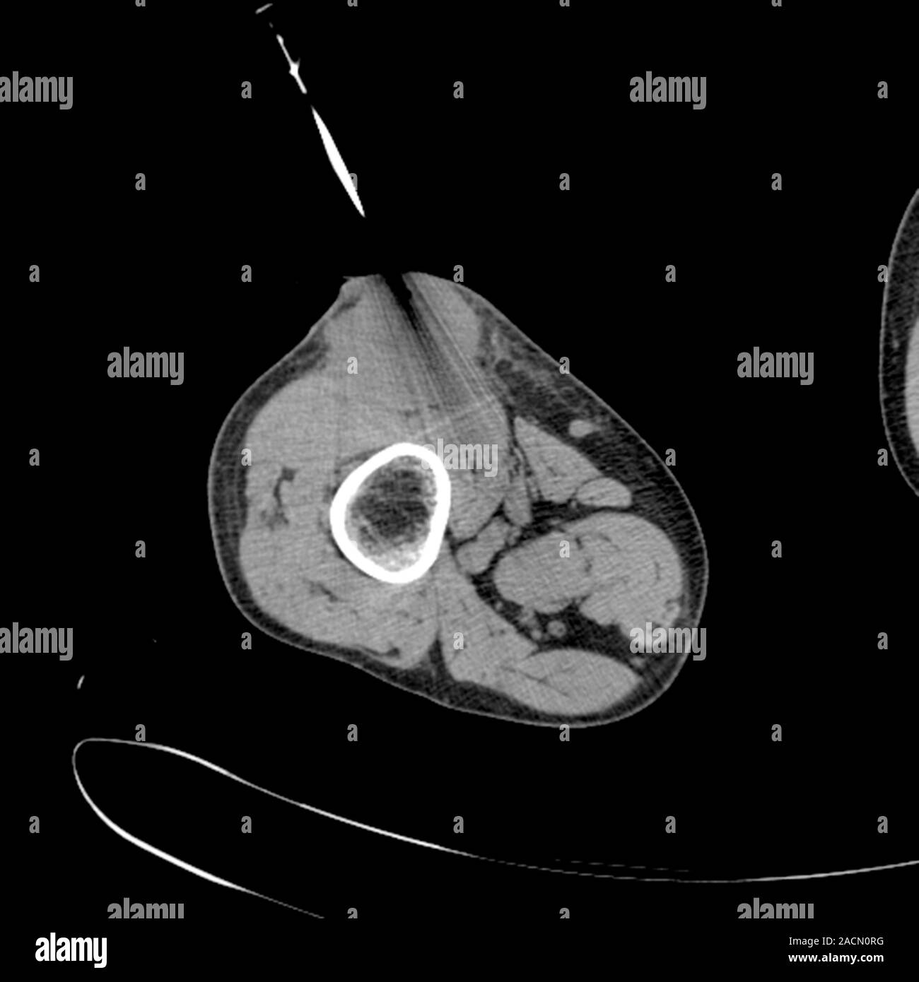 A biopsy of a malignant tumour (Sarcoma) on the right thigh of a male ...