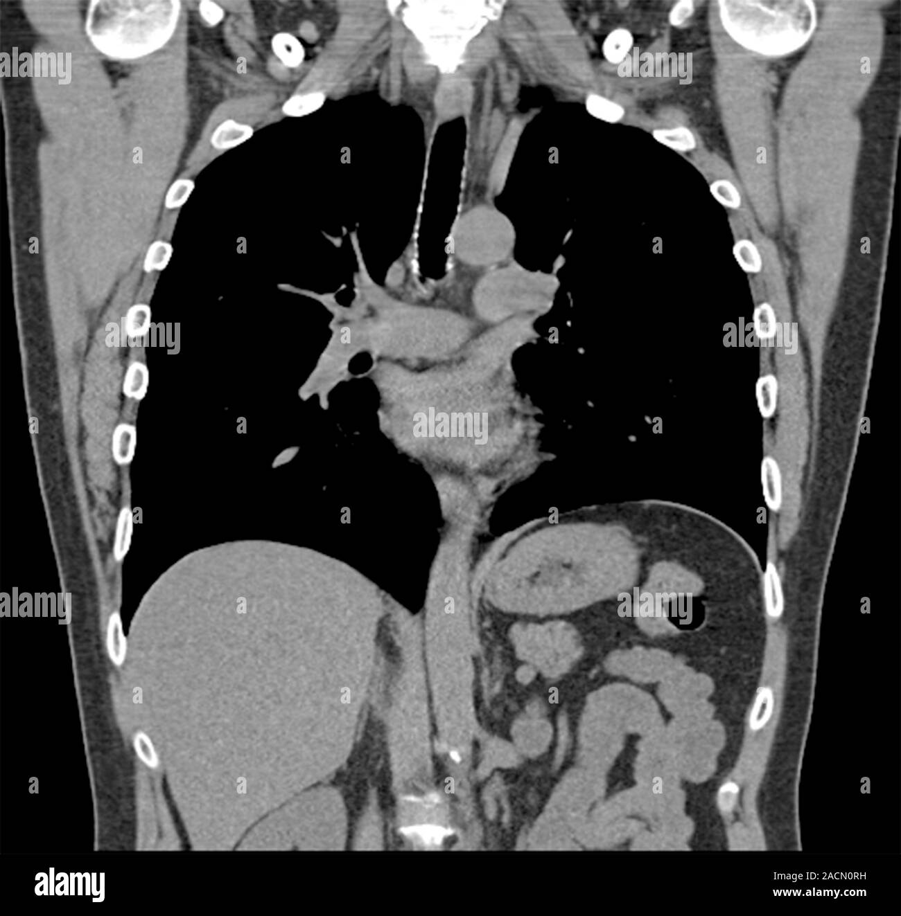 X-ray computed tomography (CT) of an adult male's chest cross section ...