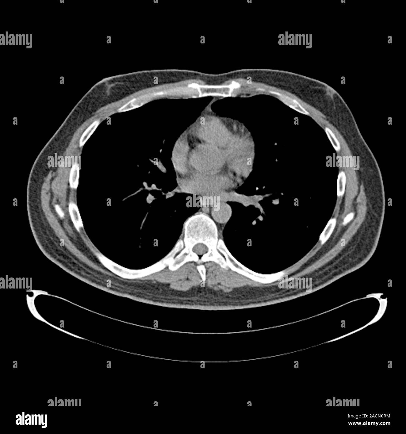 X-ray computed tomography (CT) of an adult male's chest cross section ...