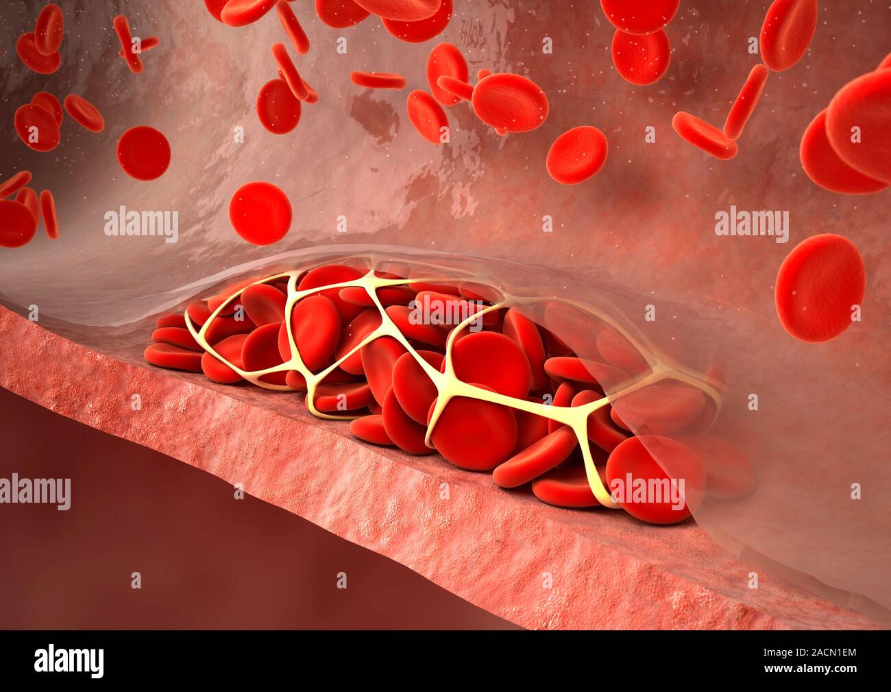 Thrombosed blood vessel. Computer artwork of a blood clot (thrombus ...
