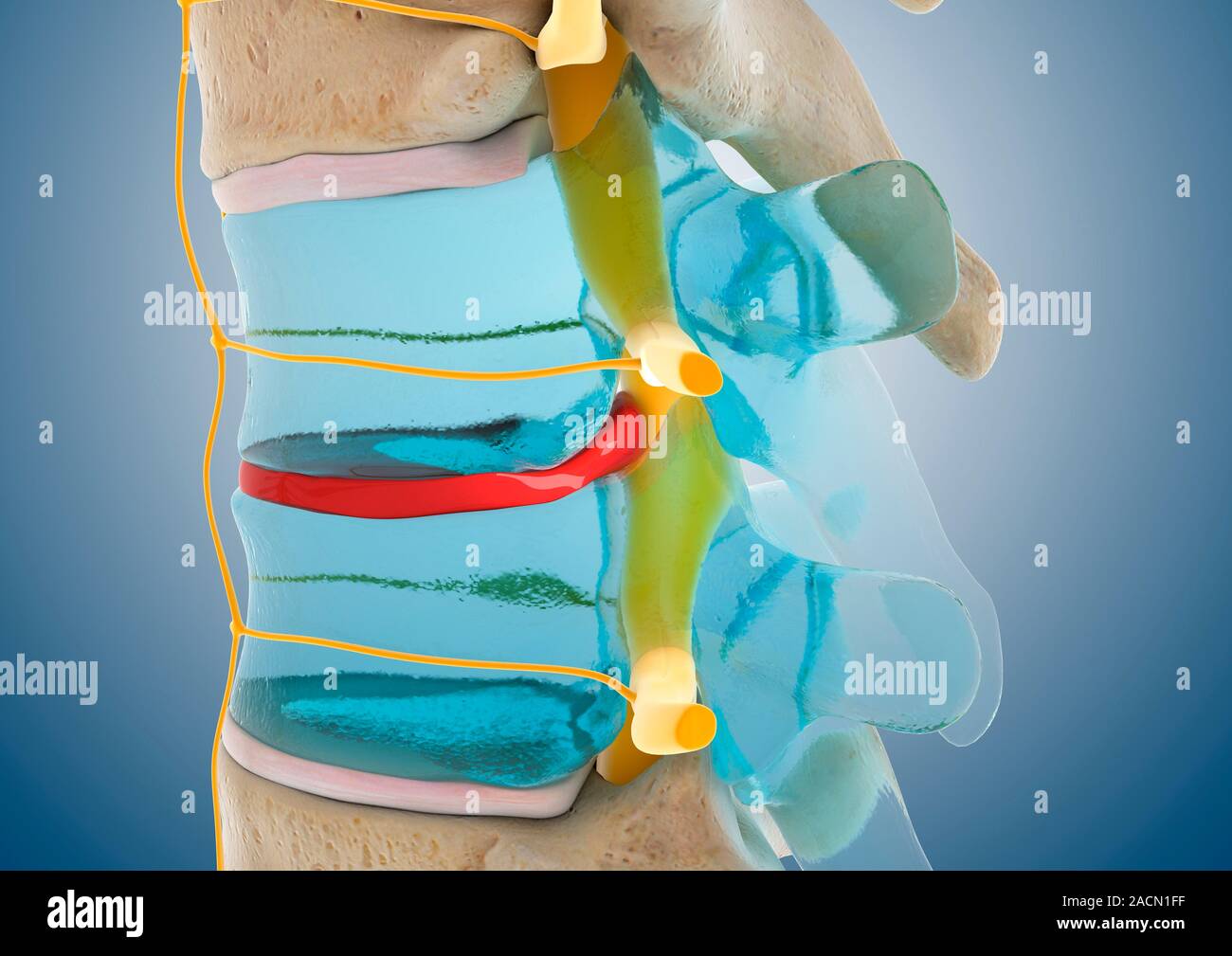 Slipped intervertebral disc. Computer artwork of a side view of the ...
