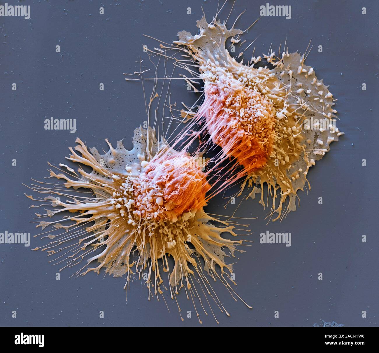Dividing cancer cells. Coloured scanning electron micrograph (SEM) of ...