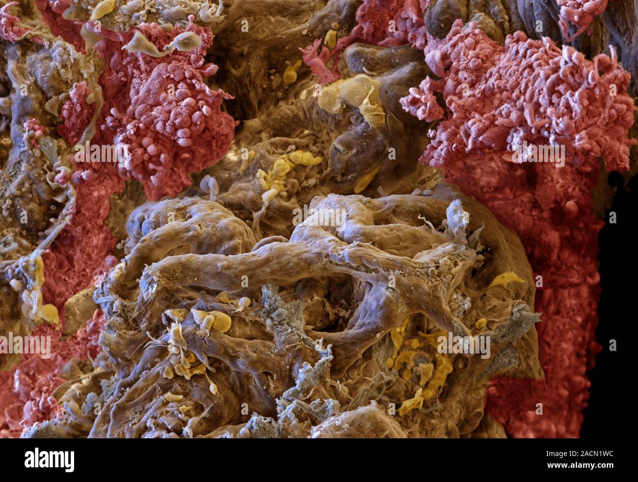 Lung cancer. Coloured scanning electron micrograph (SEM) of tissue from ...