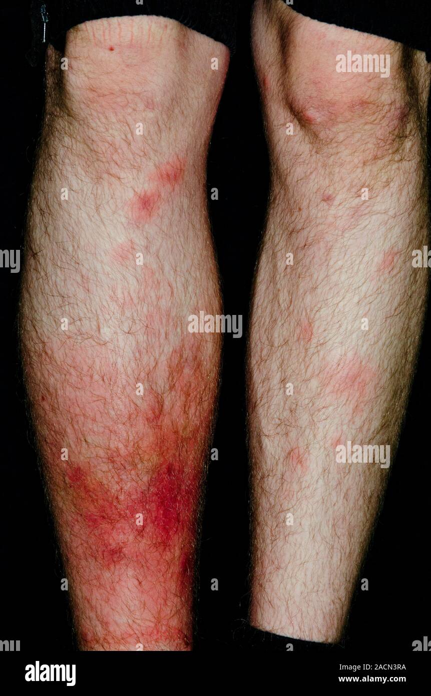 Red and inflamed skin of the leg (at left) in a 15 year old male ...