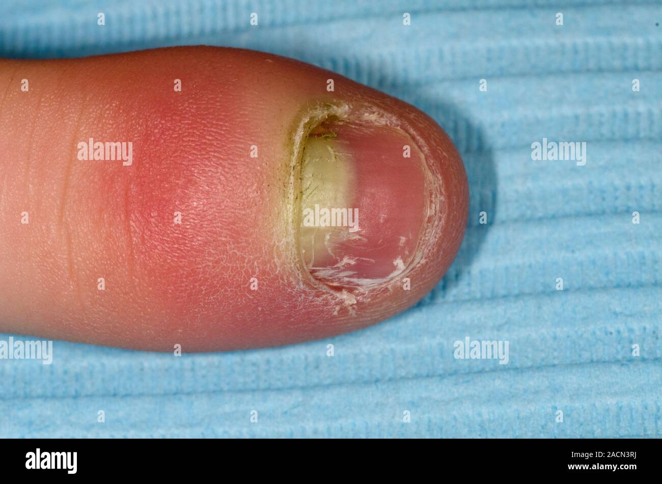 Close-up of pus under the reddened skin of the thumb from an infection ...