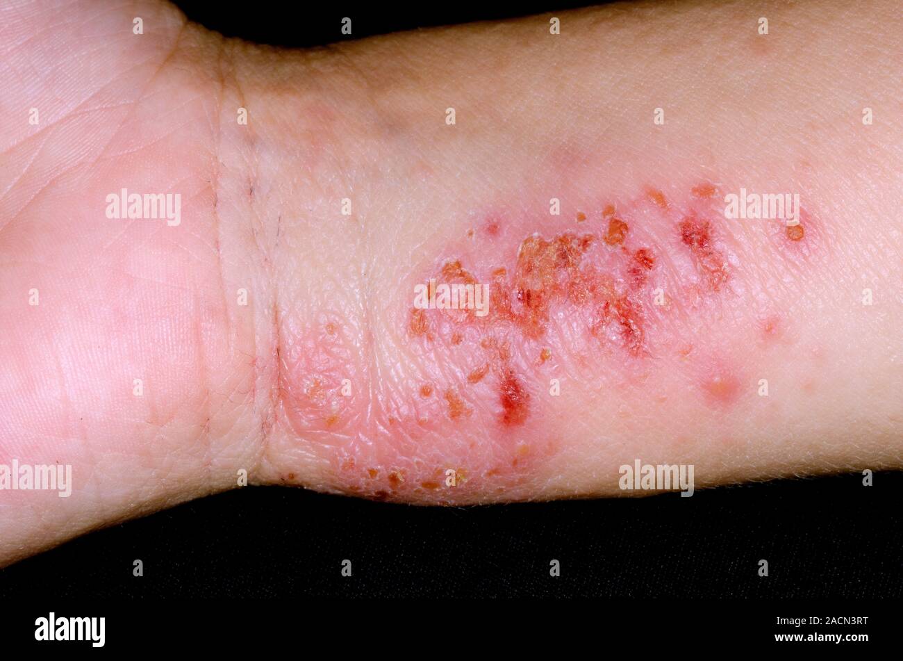 Close-up of infected eczema on the arm in a 2 year old male patient ...