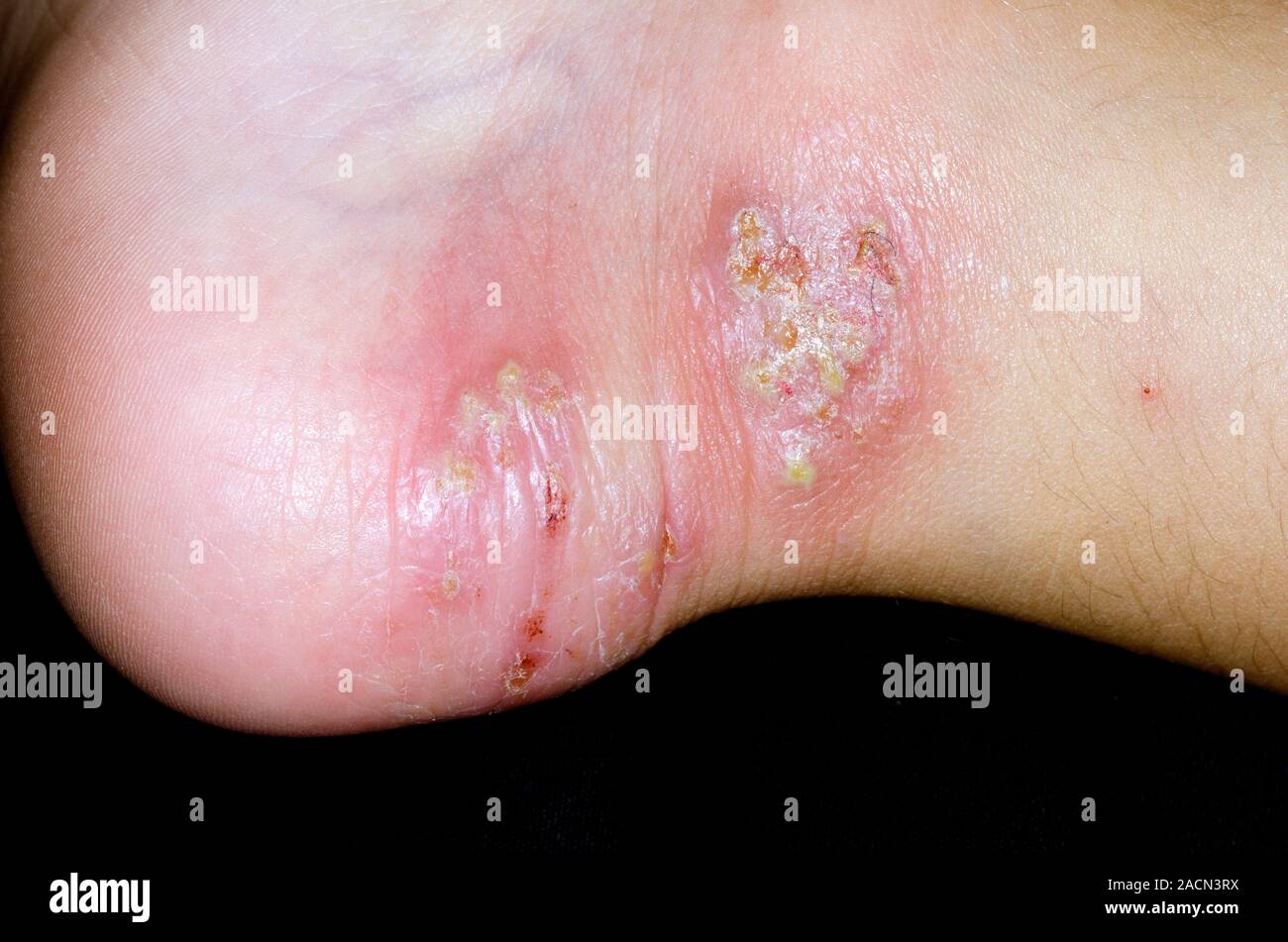 Close-up of infected eczema on the foot in a 2 year old male patient ...