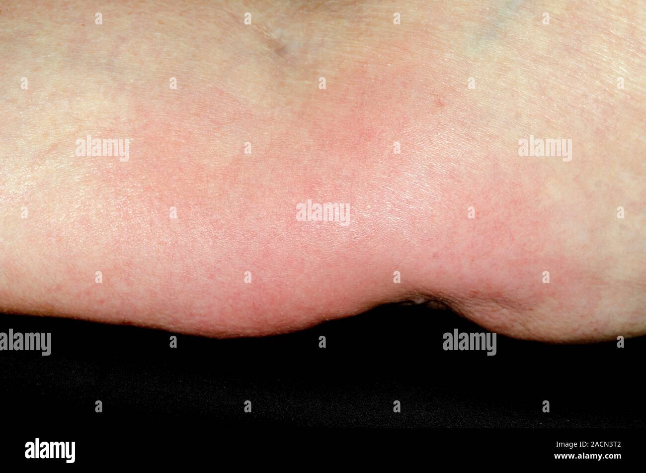 Close-up of red and inflamed skin on the elbow in a 78 year old female ...
