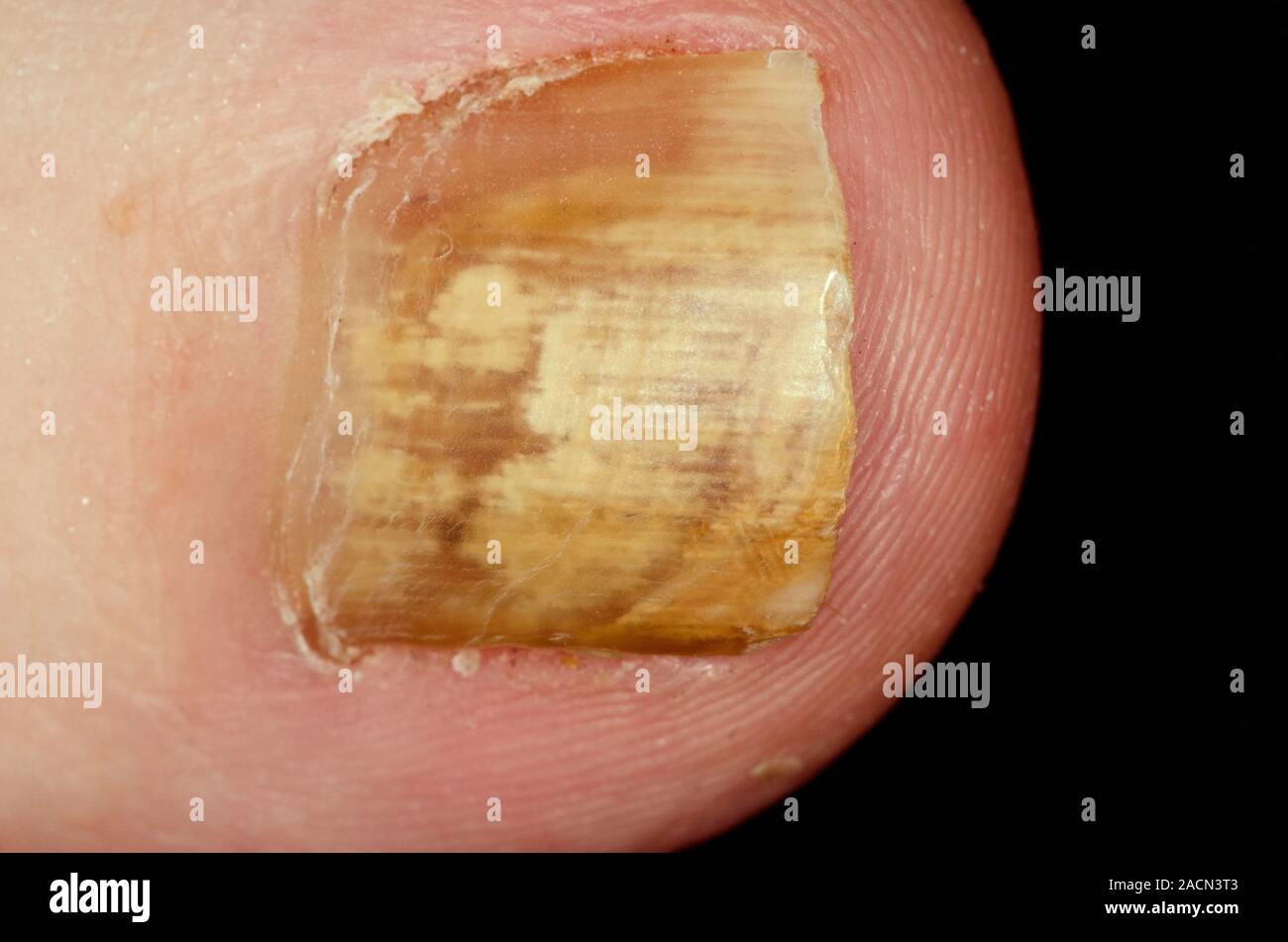 Close-up of a fungal infection of the toenail in a 34 year old male ...