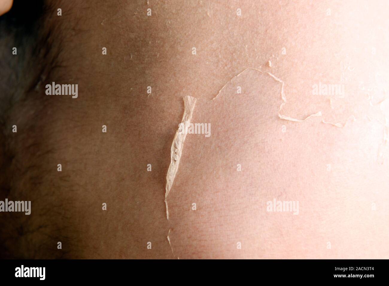 Close-up of skin peeling from the chest in a 22 year old male patient ...