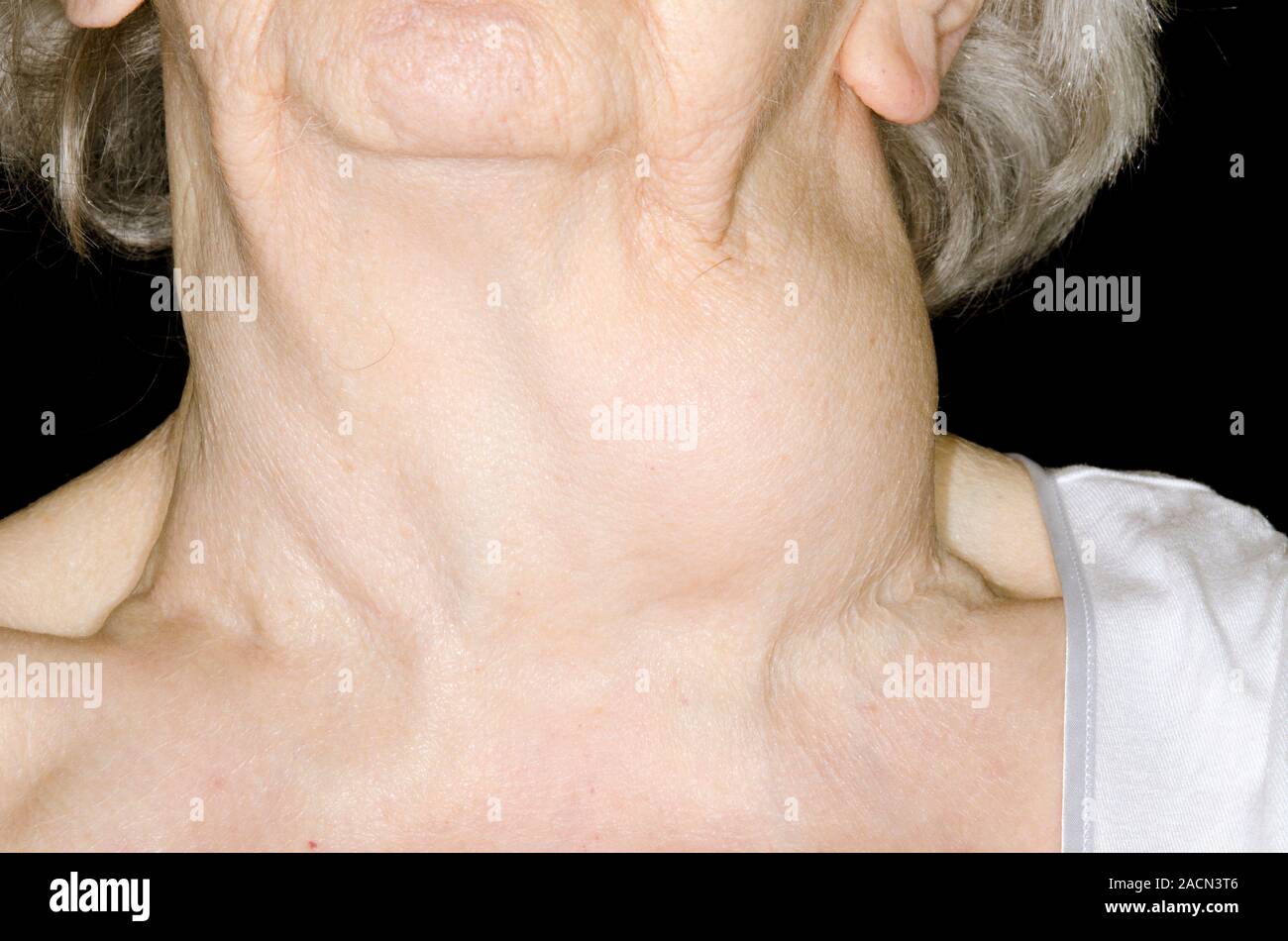 Swollen Neck Thyroid