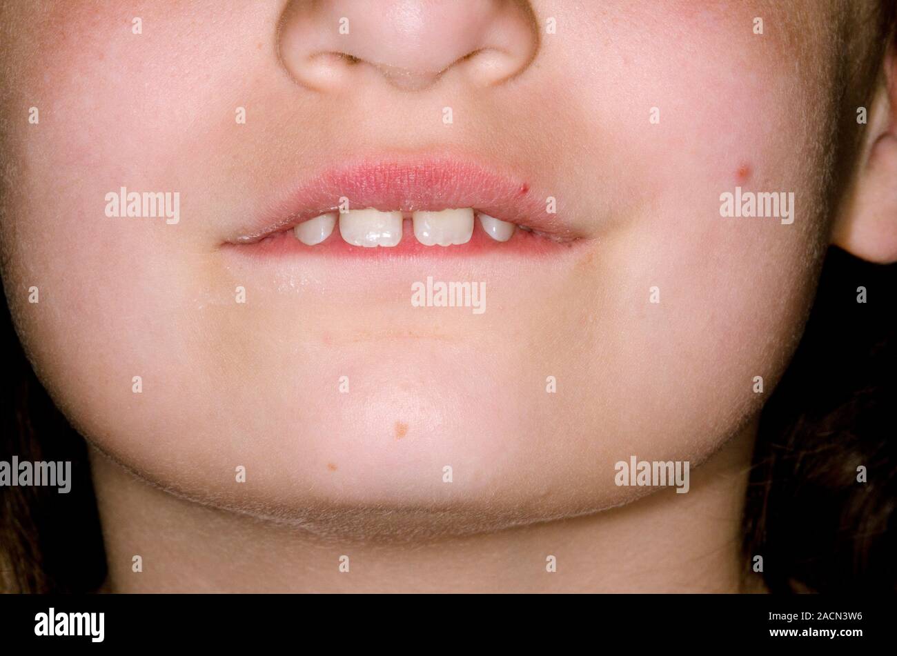 Overbite due to maloccluded teeth (class II deepbite) with hypoplastic ...