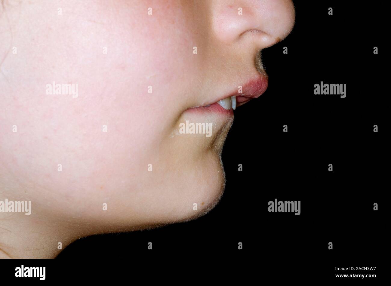 Overbite due to maloccluded teeth (class II deepbite) with hypoplastic ...