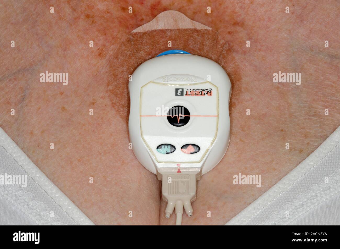 Novacor electrocardiogram (ECG) heart monitor on the chest of an ...