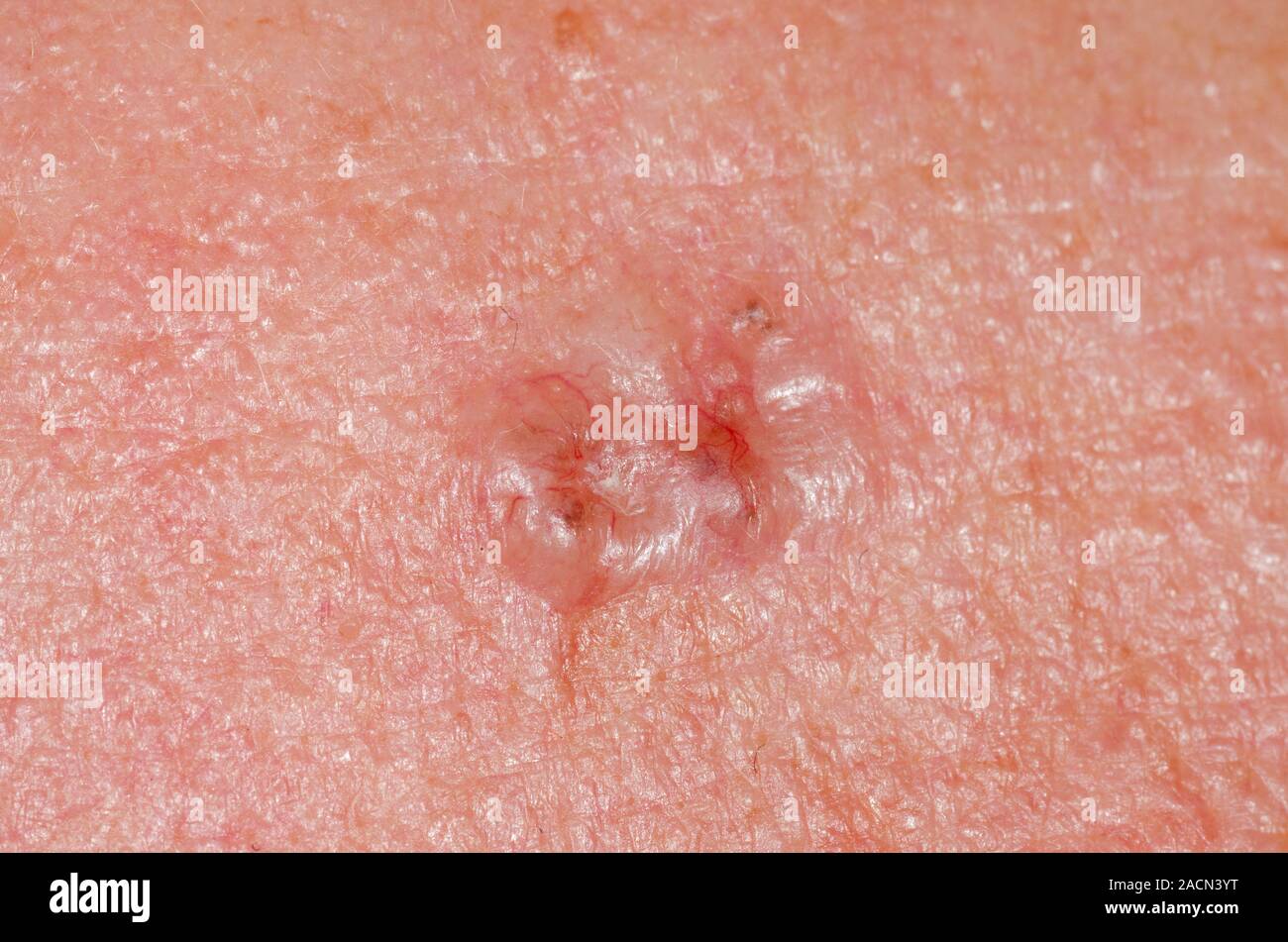 Close Up Of Basal Cell Carcinoma Bcc Or Rodent Ulcer On The Skin Of The Forehead In A 68