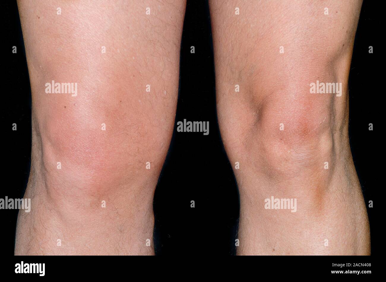 Swollen knee (at left) in a 58 year old male patient, caused by a ...