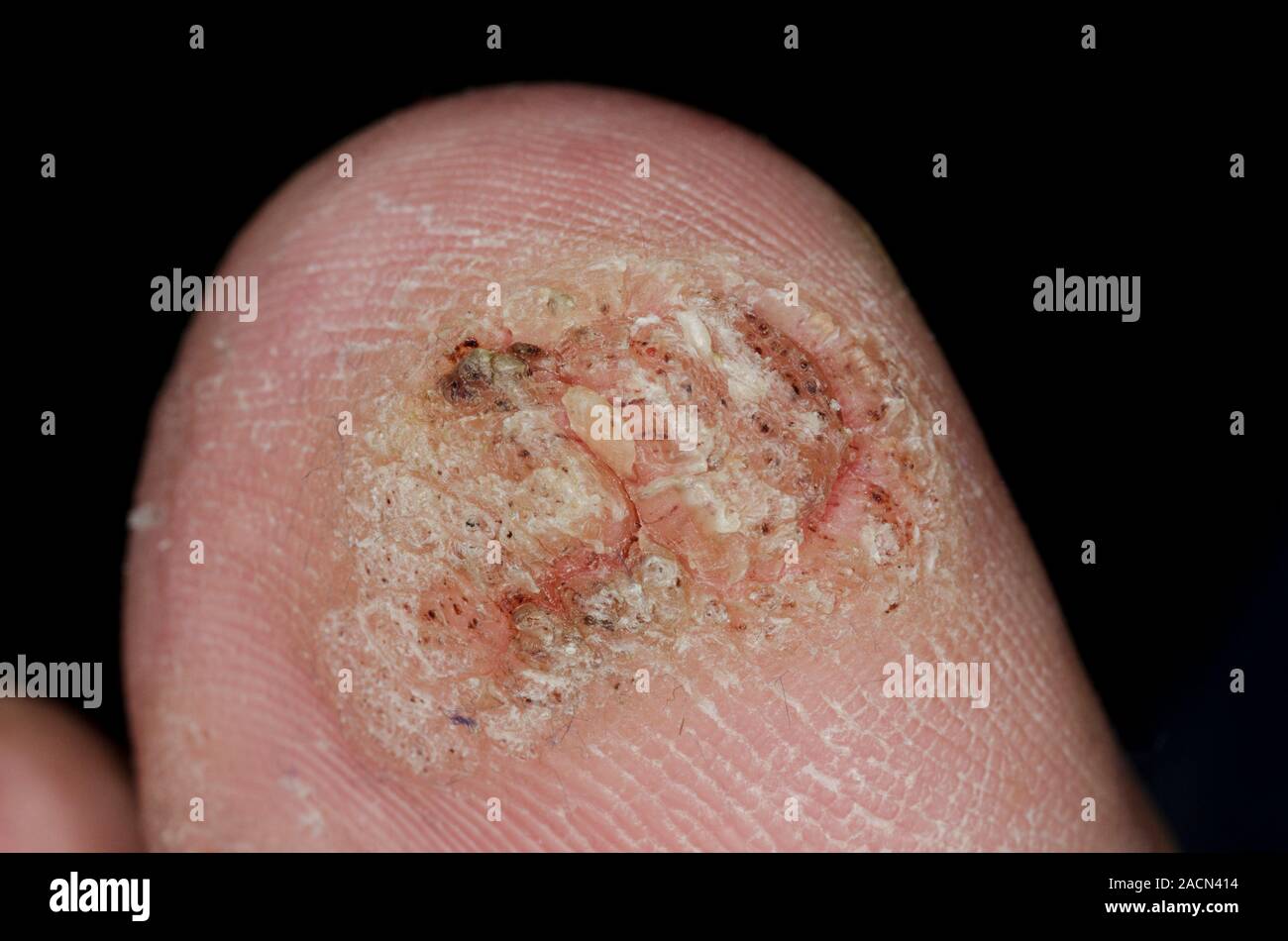 Close-up of a verruca (wart) on the big toe in a 47 year old male ...