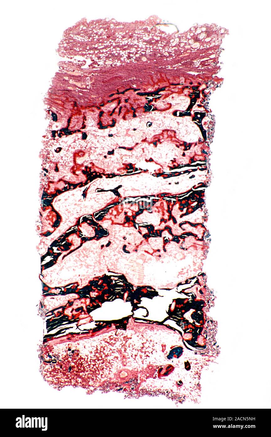 Rheumatoid arthritis. Light micrograph of a section through joint ...
