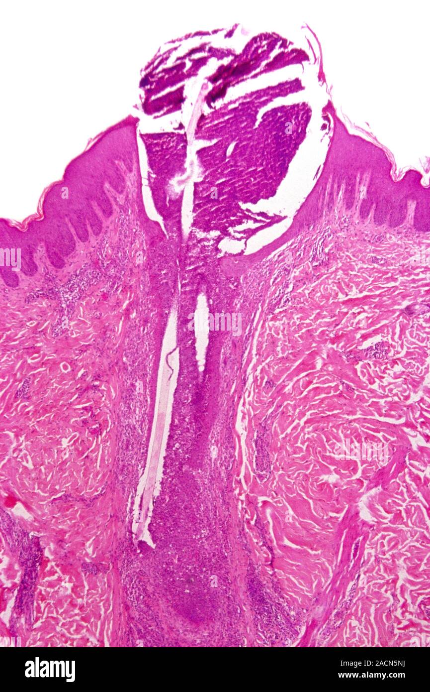 Folliculitis. Light micrograph of a section through skin showing an ...