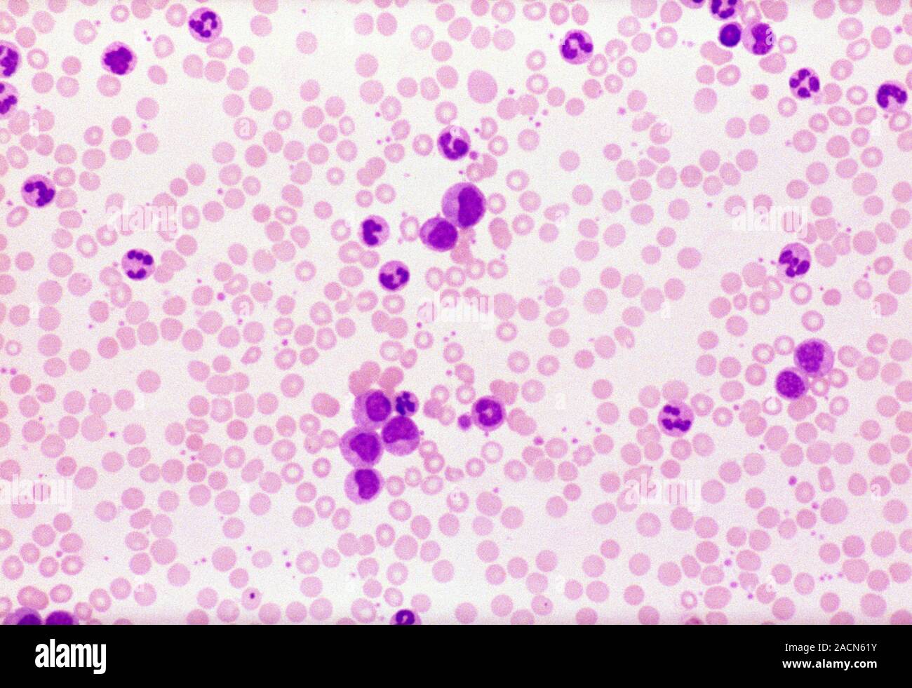 Chronic myeloid leukaemia. Light micrograph of a blood smear from a ...