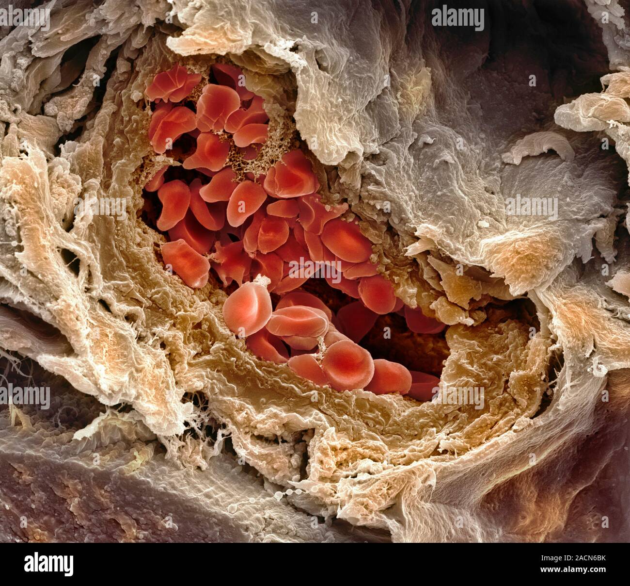 Blood-filled artery. Coloured scanning electron micrograph (SEM) of a ...