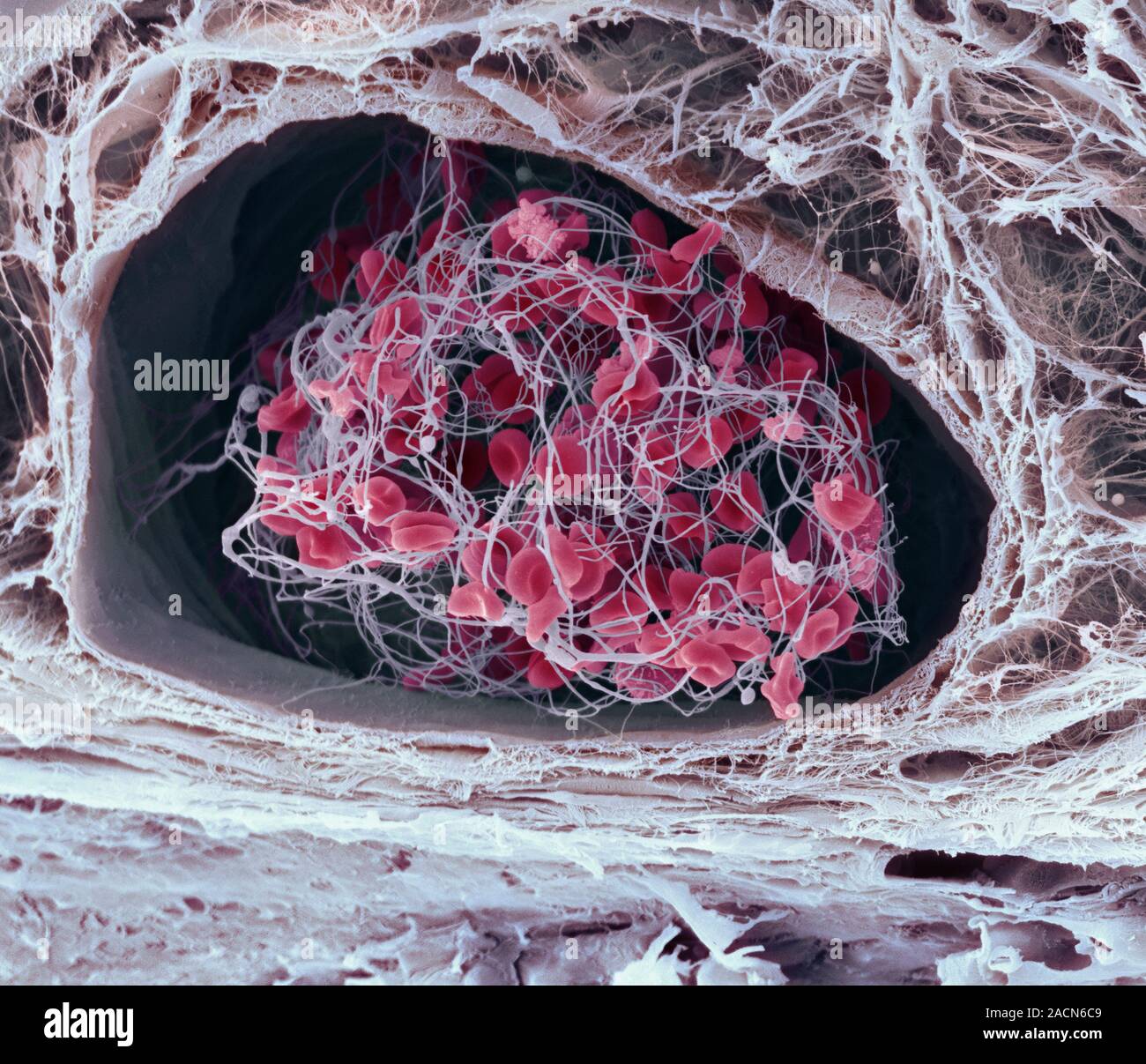 Blood clot. Coloured scanning electron micrograph (SEM) of a blood clot ...