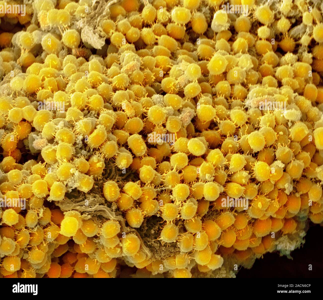 Gingivitis. Coloured scanning electron micrograph (SEM) of a large ...